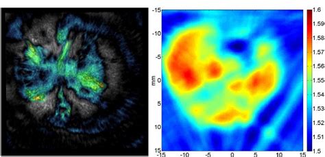 Advanced Image Reconstruction For Ultrasound Photoacoustic Computed Tomography
