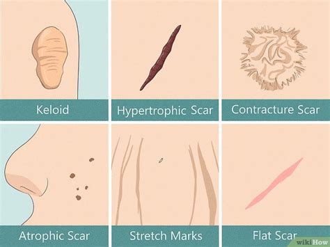How To Break Up Scar Tissue Effective Treatment Options
