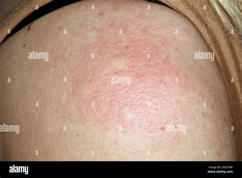Spider Bite Allergic Reaction How To Treat Insect Bites