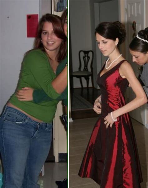 Woman ‘physically Sick After Her Anorexia Photo Used In ‘amazing