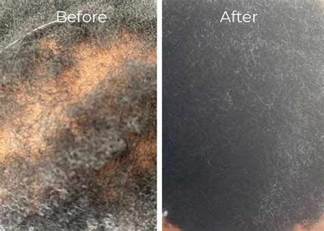 Results And Testimonials Life Hair Restoration Clinic