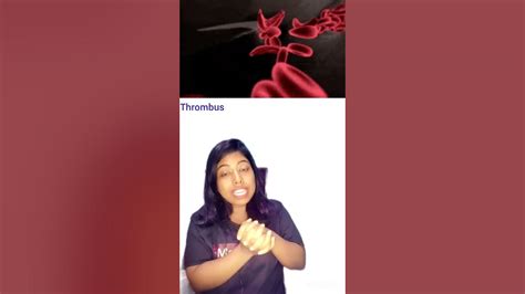 Thrombus Vs Embolus Haematology Medicallabtechnology Youtube