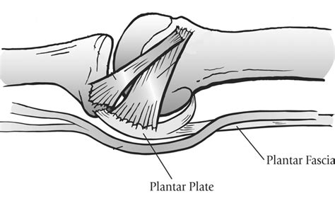 Plantar Plate Wikism Sports Medicine Wiki