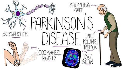 Parkinsons Disease Rigidity At Janice Mayo Blog