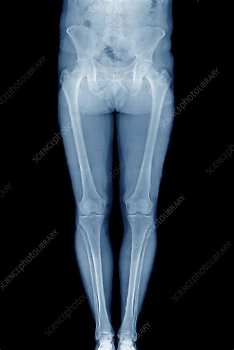 Healthy Leg Bones X Ray Stock Image C0037261 Science Photo Library