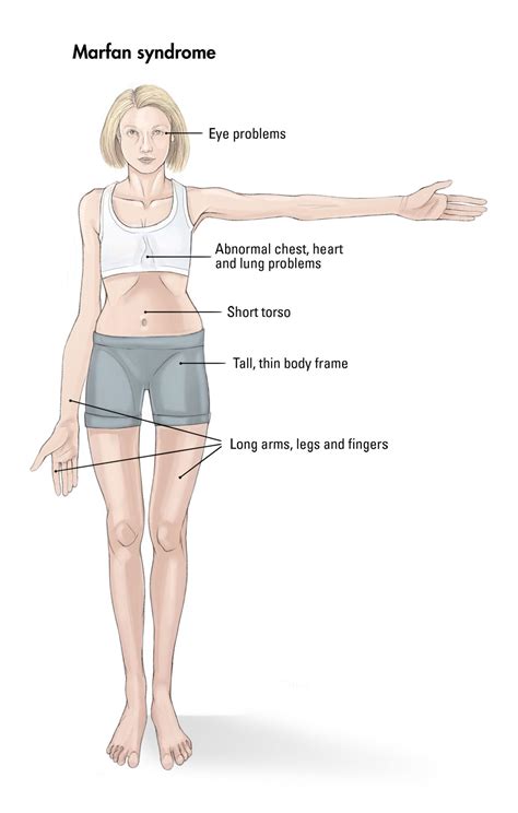 Marfan Syndrome