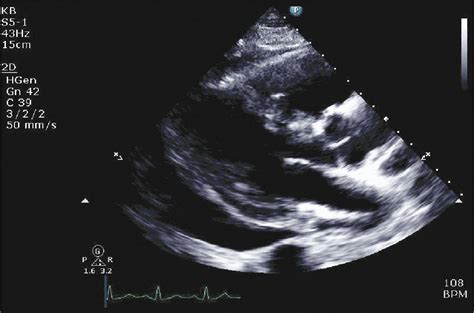 Pericarditis Echo