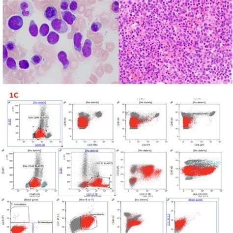 A 1000x Immature Mononuclear Cells On Aml Bone Marrow Aspirate Download Scientific Diagram