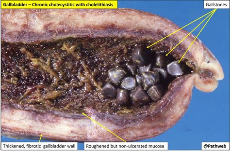 Chronic Cholecystitis Cholecystitis