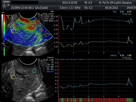 Cervical Elastographic Evaluation In The Elastography Analysis Program Download Scientific