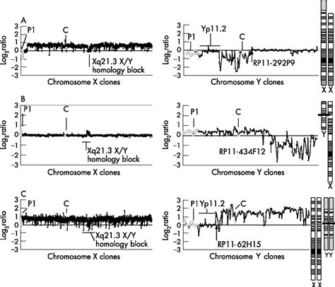 Analysis Of Sex Chromosome Abnormalities Using X And Y Chromosome Dna