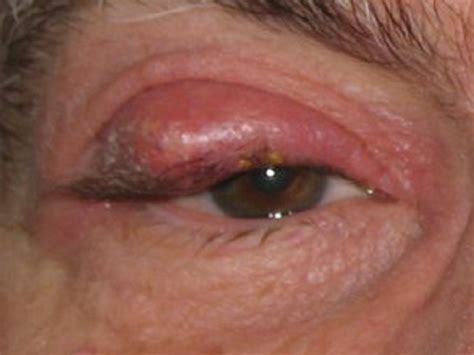 Will Antibiotic Eye Drops Help A Chalazion At Nancy Hansen Blog