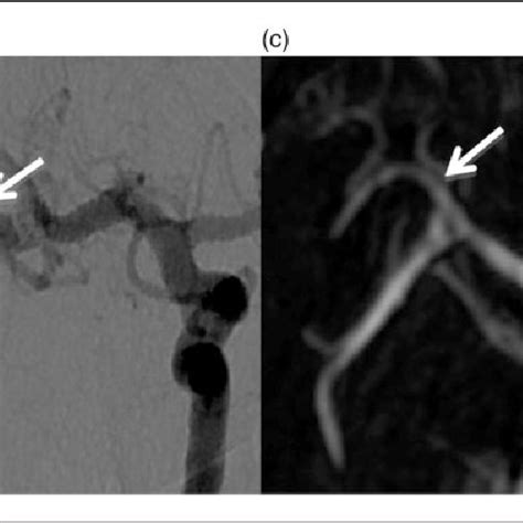 Comparative Analysis Of Cta And Mra Versus Dsa For Intracranial Stenosis Download Table