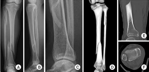 A C Anteroposterior Lateral X Rays Of Distal One Third A Tibial Shaft Download Scientific