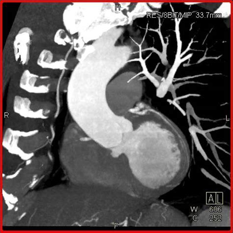 Dilated Ascending Aorta As Well As Coronary Artery Disease Vascular