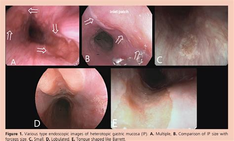 Esophageal Inlet Patch Demographic And Endoscopic Characteristics Of