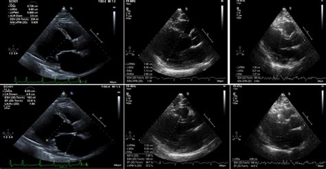 Echocardiogram Showing Severely Reduced Lvef And Dilated Left Ventricle