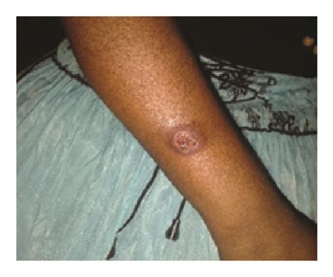 Different Stages Of A Skin Lesion In Leishmaniasis A Early Papular