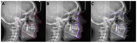 Comparison Of Three Commercially Available Ai Driven Cephalometric