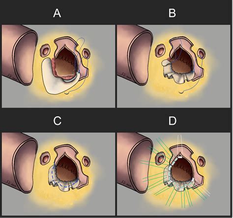 Aortomitral Curtain Reconstruction Demystifying A Complicated