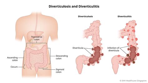 Diverticulosis And Diverticulitis Causes And Symptoms Parkway East