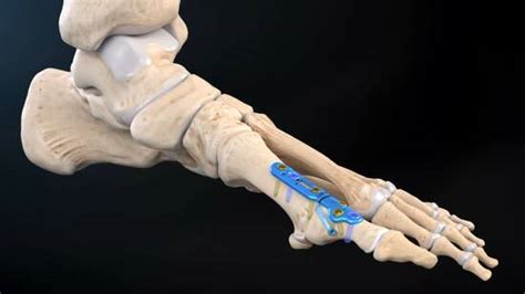 Big Toe Arthritis Great Toe Joint Fusion With A Plate And Screws Animation Orthopedia Patient
