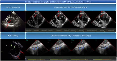 Intracardiac Echocardiography Techniques To Identify Ventricular