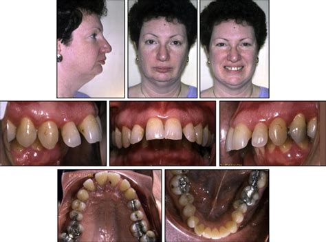 Nonsurgical Treatment Of An Adult With A Skeletal Class Ii Division 1