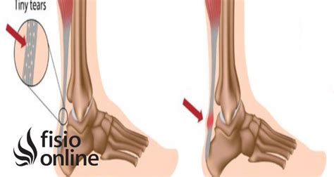 Tendinosis Qué Es Qué Estructuras Afecta Síntomas Signos Clínicos