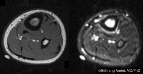 Roentgen Ray Reader Fredericson Grading Of Tibial Stress Reaction
