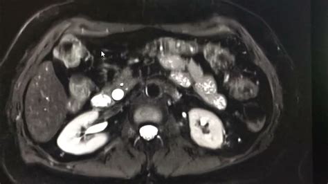 Interesting Case No 32 Mrcp Cbd Stone Radarchif Youtube