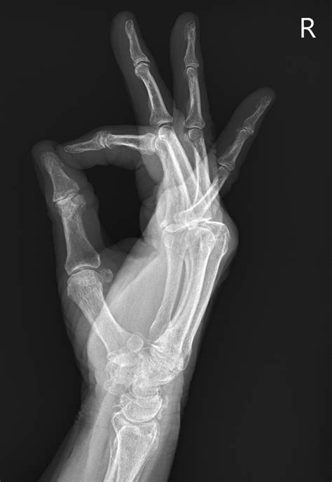 Osteoarthritis With Cppd Image Osteoarthritis With Cppd Image