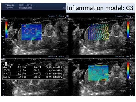 BÀi SoẠn VỀ SiÊu Âm ChẨn ĐoÁn Shear Wave Dispersion Imaging For Liver