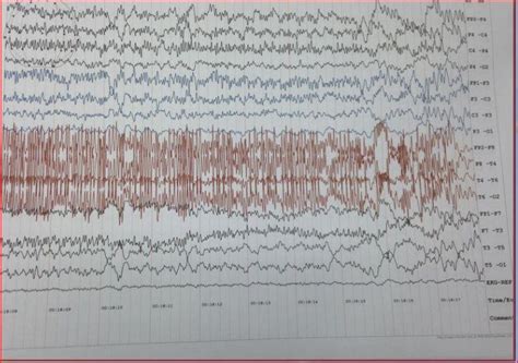 Another Eeg Tracing Showing Epileptiform Discharges From Right Frontal