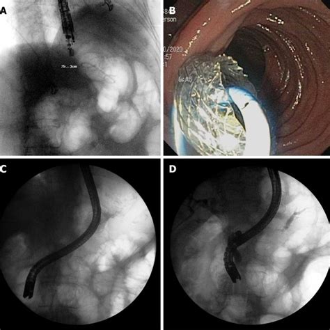 Endoscopic Ultrasonography Directed Transgastric Endoscopic Retrograde Download Scientific