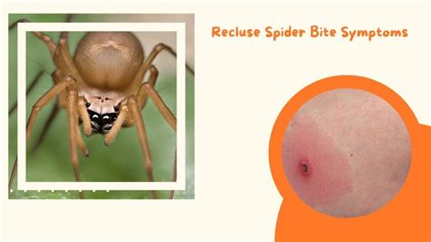 17 Types Of Spider Bite Symptoms Id With Pictures