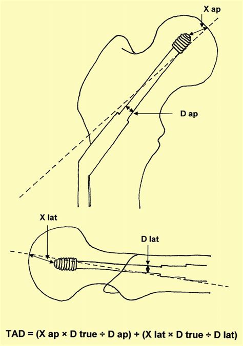 Method Of Calculating Tip Apex Distance From Radiographs D True Is The Download Scientific