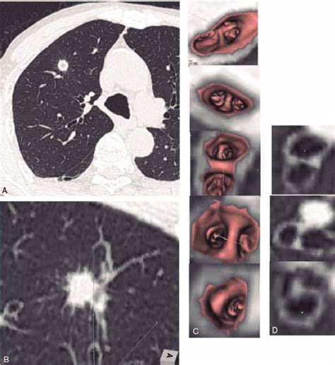 A No Bronchus Sign Is Seen Using Axial Computed Tomography Ct B Download Scientific