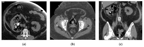 Male Ureter Ct Scan