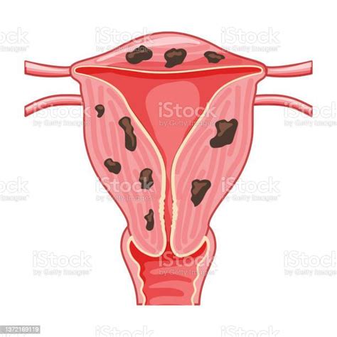 아데노미증 초점 암 인간 해부학 여성 생식 아픈 시스템 기관 아이콘 벡터 의료 일러스트레이션 흰색 배경에 격리 내부 기관 현실적인 도면의 단면 자궁내막증에 대한 스톡 벡터