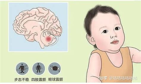 共济失调早期是什么表现一般能活多久 知乎