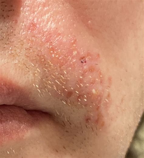 Upper Lip Is This Swelling And Redness Normal After 3 Days