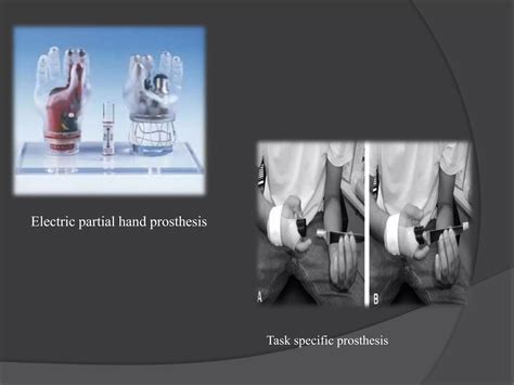 Socket Variants In Upper Extremity Prosthesis Pptx1 Ppt