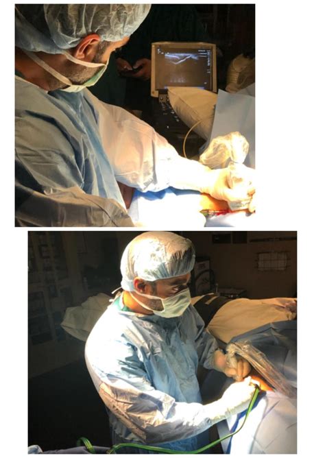 Percutaneous Extensor Carpi Radialis Brevis Tendon Repair Tennis Elbow