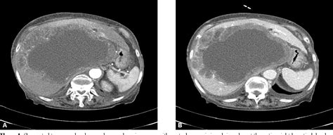 Figure 1 From A Case Of Huge Hepatic Recurrence Of Low Risk