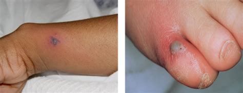 Osteomyelitis Septic Arthritis Gonococcal Arthritis Bone Neoplasms