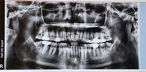 치과 파노라마엑스레이 신경치료 사진 해석좀 부탁드립니다 ㅣ 궁금할 땐 아하
