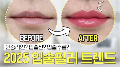 내돈내산 솔직후기 티 안 나게 어려지는 2025 입술필러 트렌드👄💉 부작용 가격 병원 고르는 꿀팁 통증 붓기 국산