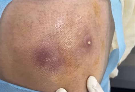 Infected Injection Site Abscess Treatment New Pimple Popping Videos