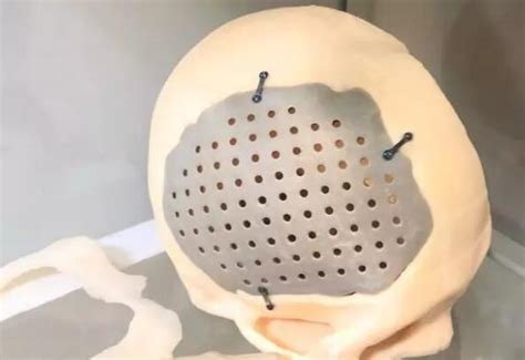 3D打印PEEK医疗植入物企业麦递途医疗获赢创投资数百万欧元 3D科学谷